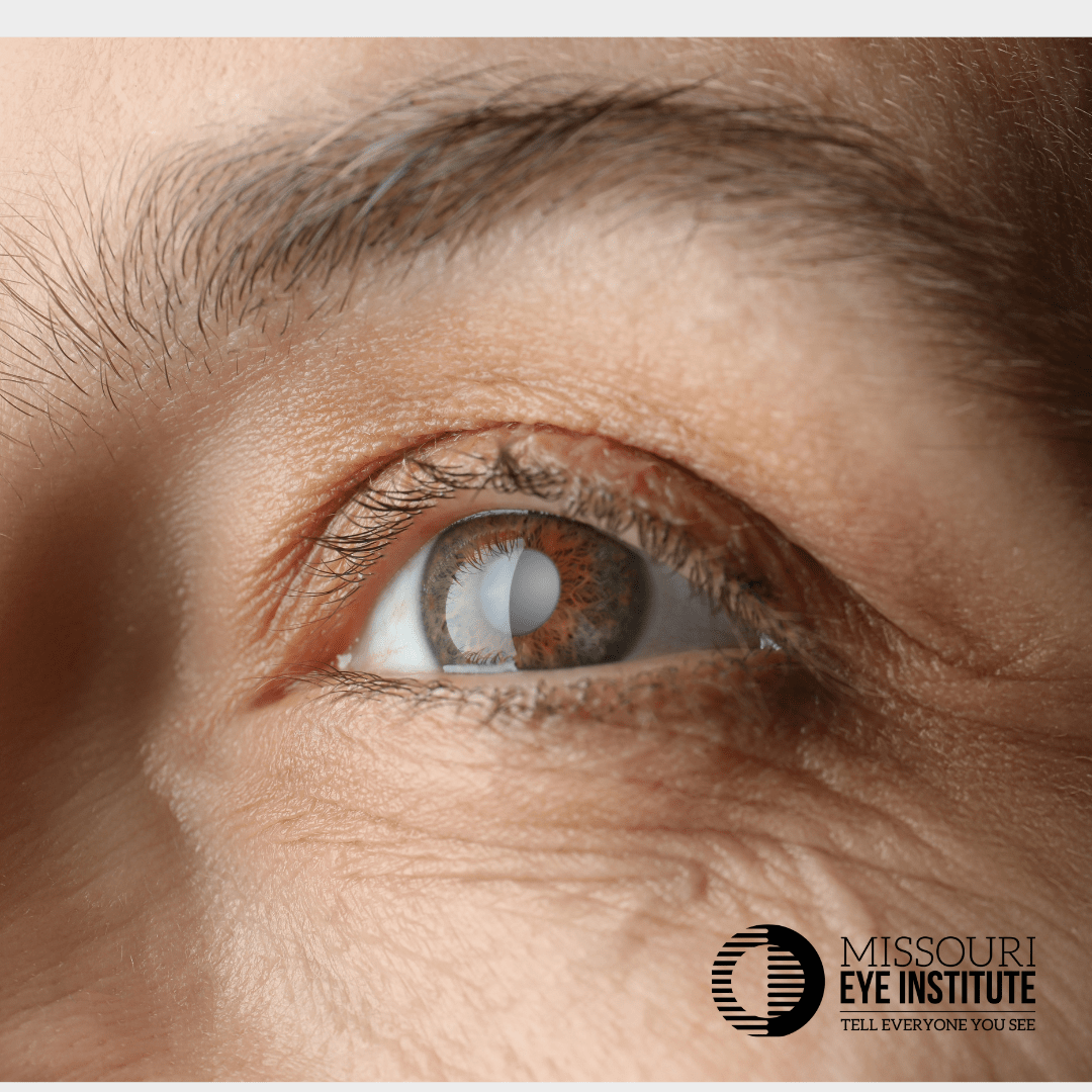 Don’t Believe the Myths! 5 Facts About Cataracts and Your Vision ...